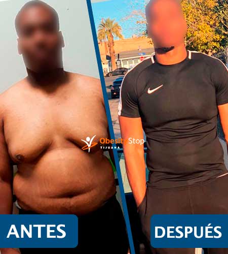 Manga Gastrica En Tijuana